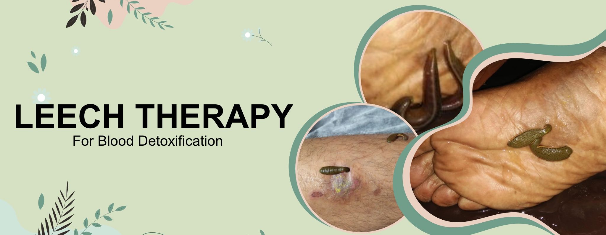 RaktaMokshan (Leech Therapy) - Ayulife